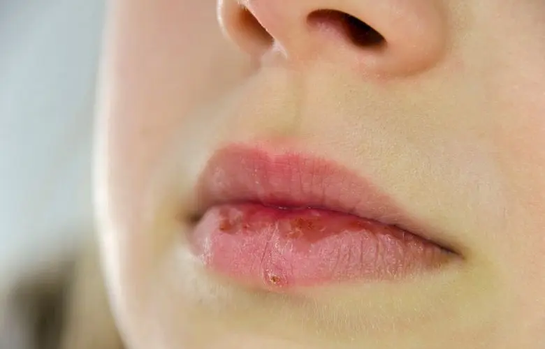 Estagios De Labios De Herpes