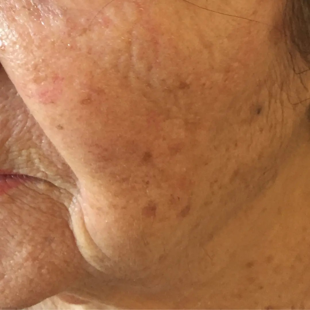Lentigos Solares Por Dermatologo